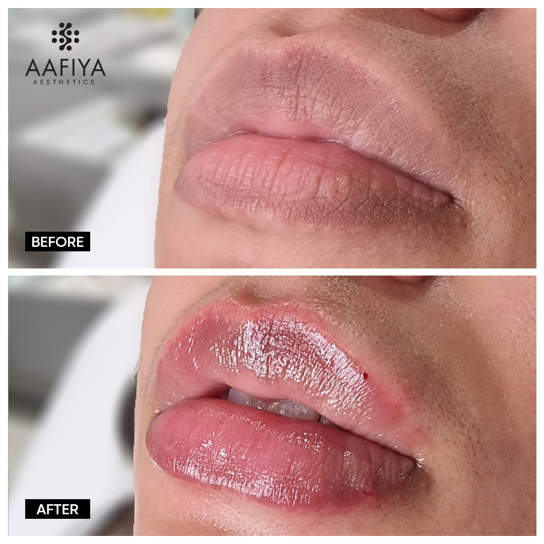 Lip Fillers Aafiya Aesthetics Lip Fillers Aafiya Aesthetics